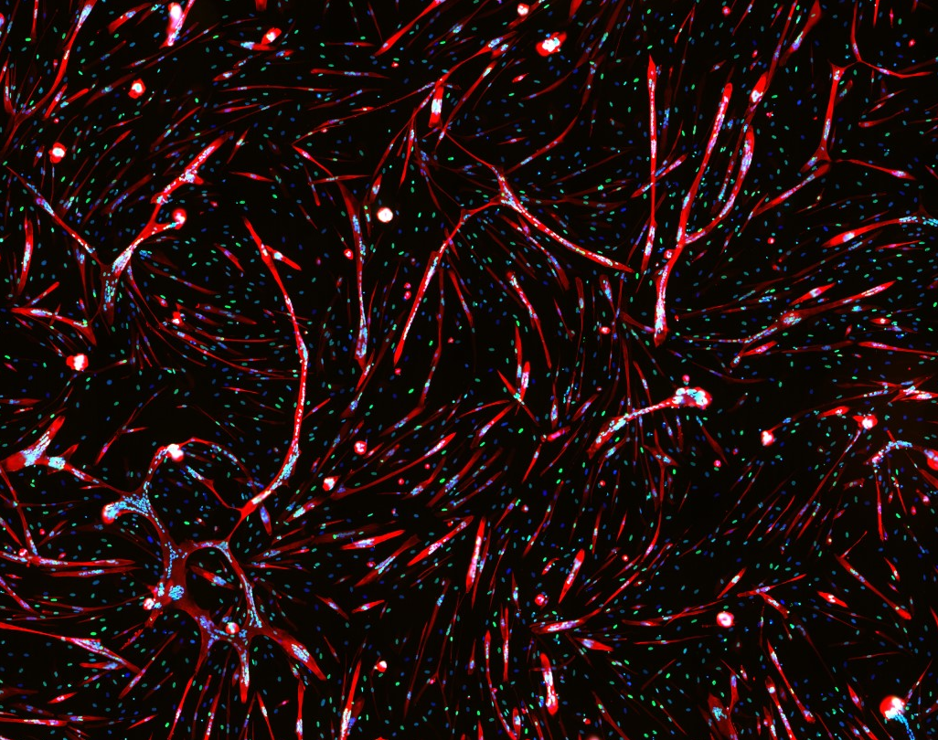 Gentherapie voor myotone dystrofie - Spierfonds